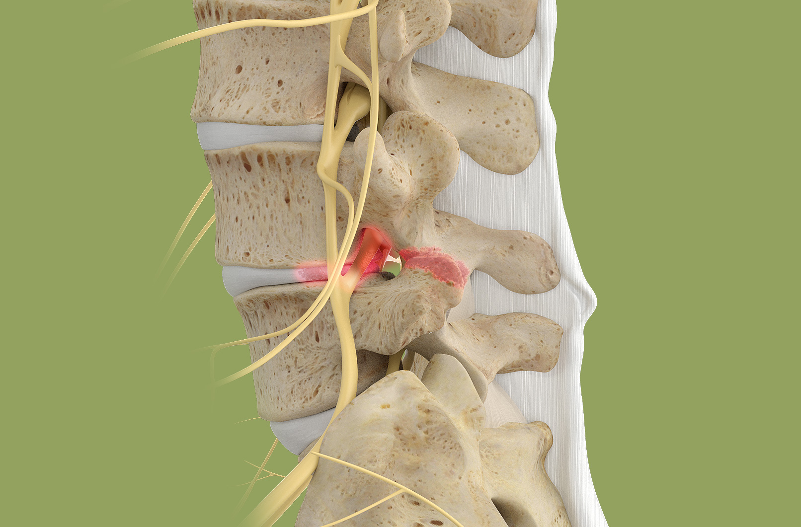 DIAMPATIENT | Companion Spine